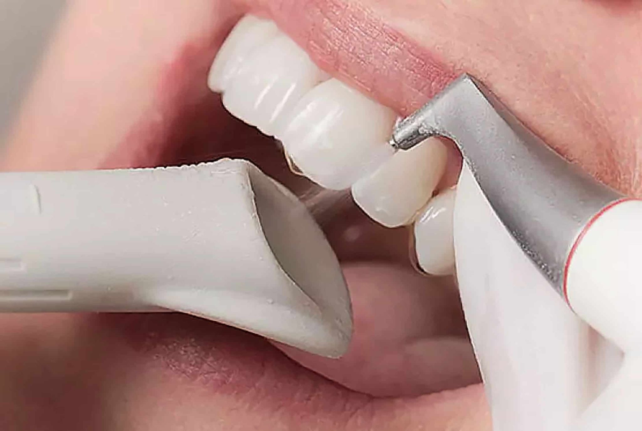 Hygienist Care & Airflow - Ham Dental